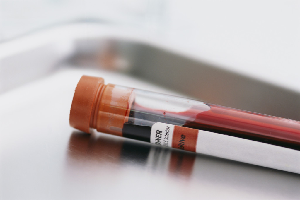 Blood Sample Tests In DUI Cases Massachusetts Criminal Defense Blood Sample Tests In DUI Cases Massachusetts Criminal Defense